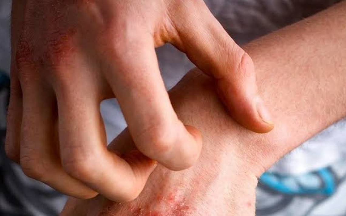 La dermatitis atópica y el asma son enfermedades causadas por una ...